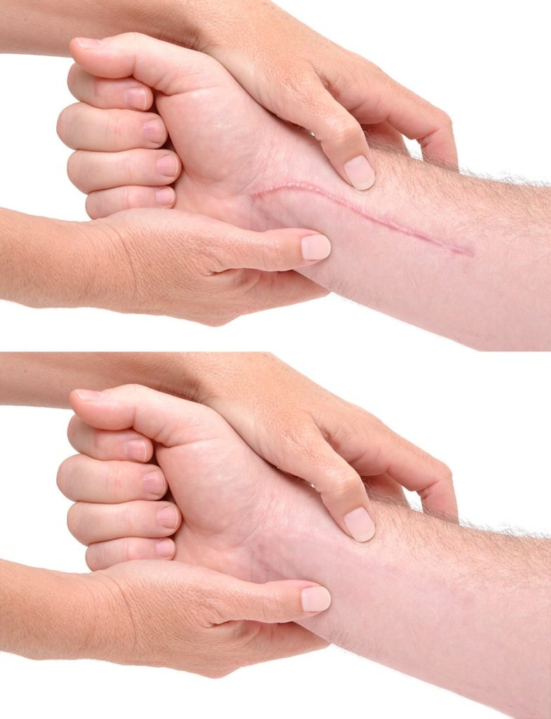 Scar Revision - Dermcare Physicians and Surgeons | Massachusetts