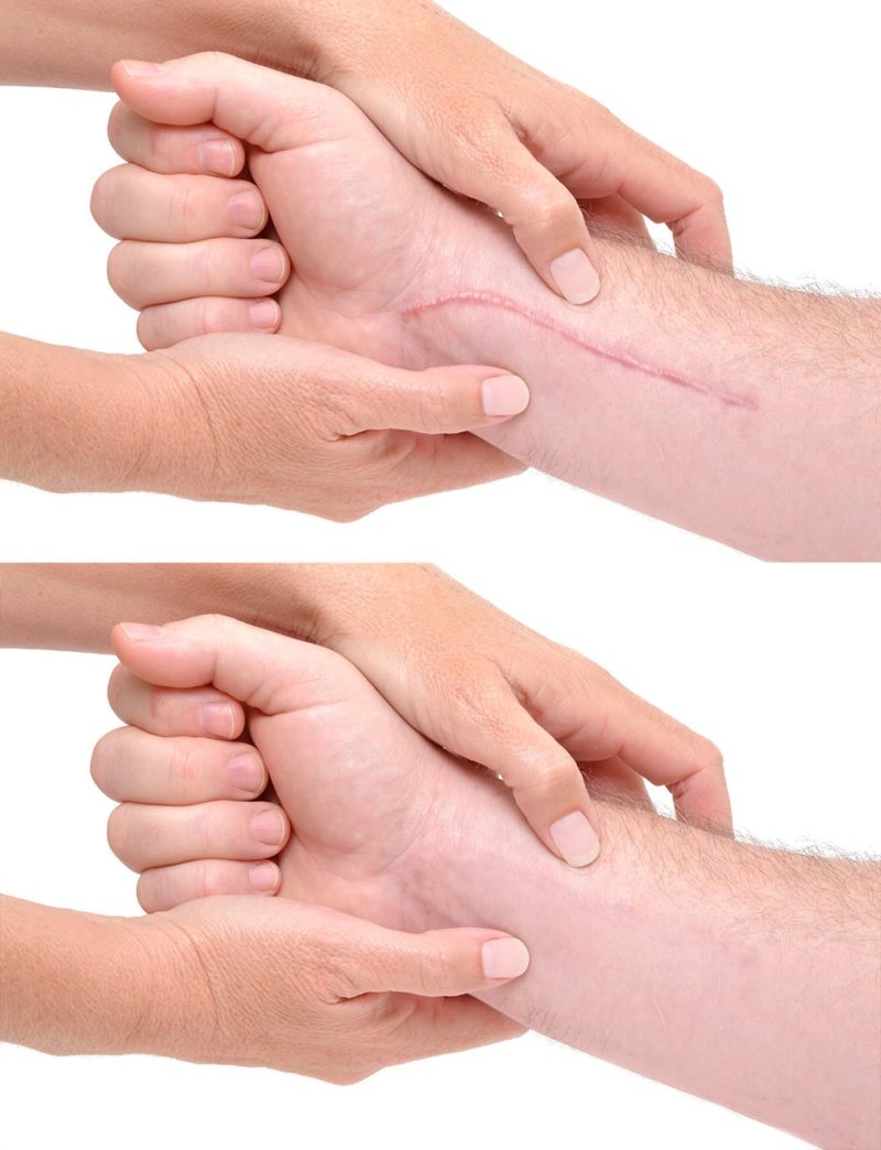 Scar Revision - Dermcare Physicians and Surgeons | Massachusetts